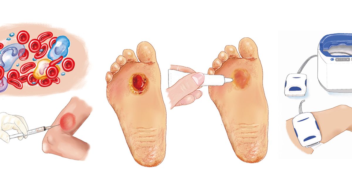 Eikö haava parane? Tässä kolme uutta hoitomenetelmää | Tehy-lehti